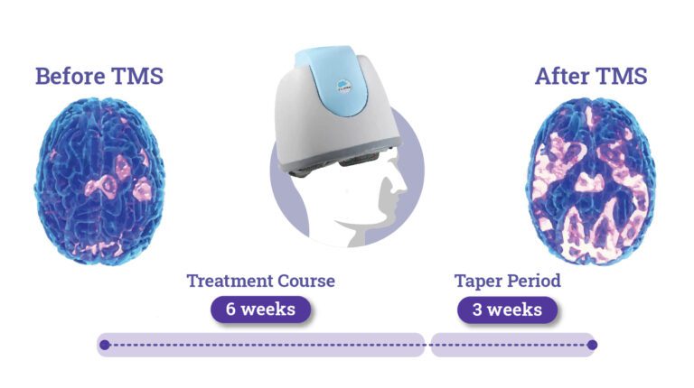 What Does TMS Stand For? | Madison Avenue TMS & Psychiatry
